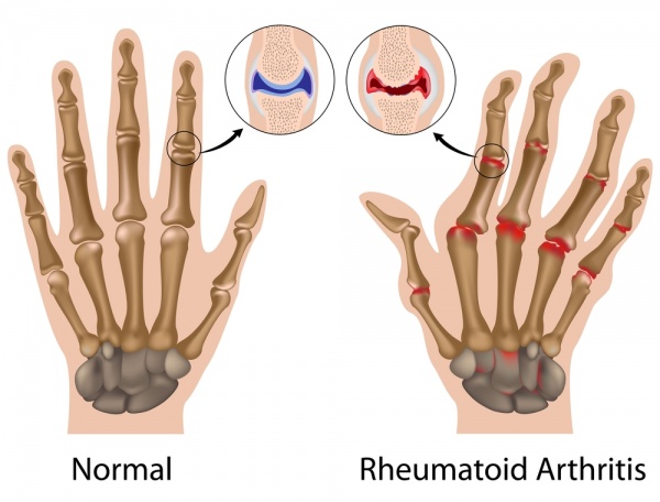 Rheumatoid Arthritis - Health Facts
