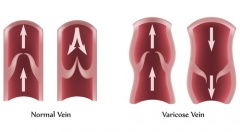 Varicose Veins - Health Facts
